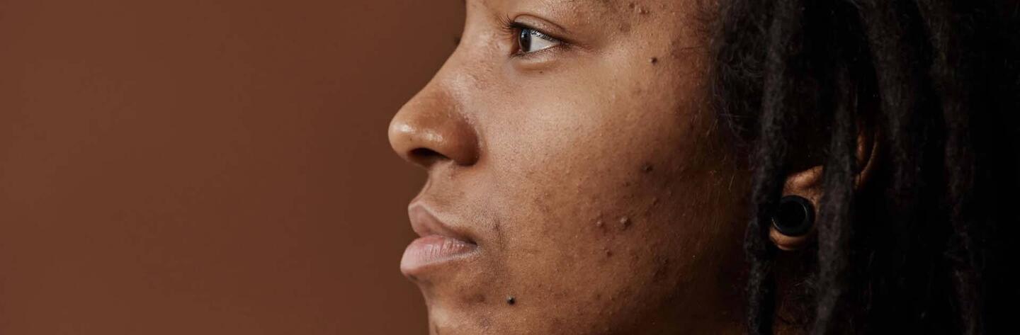 Já ouviu falar em acne escoriada?