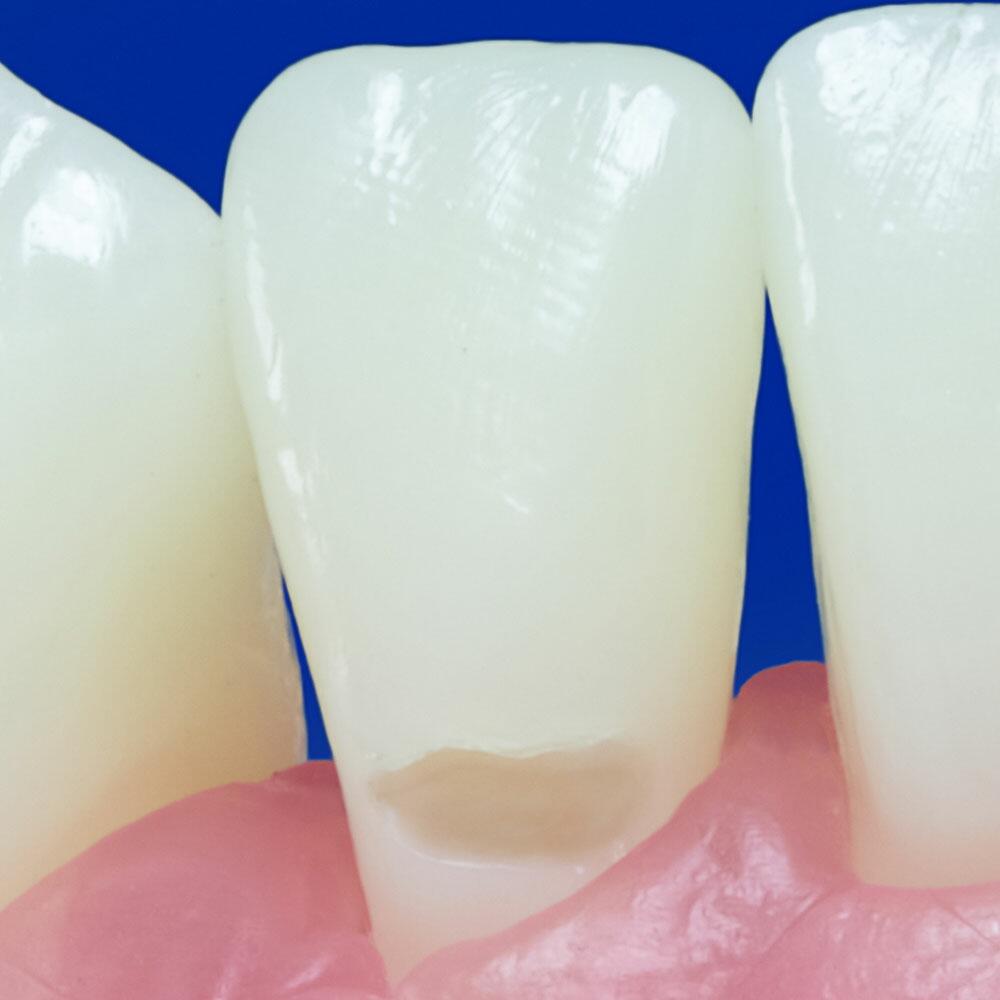 Comprar Dente Diferenciado 42 Classe V Prodens - a partir de R$8,45 ...
