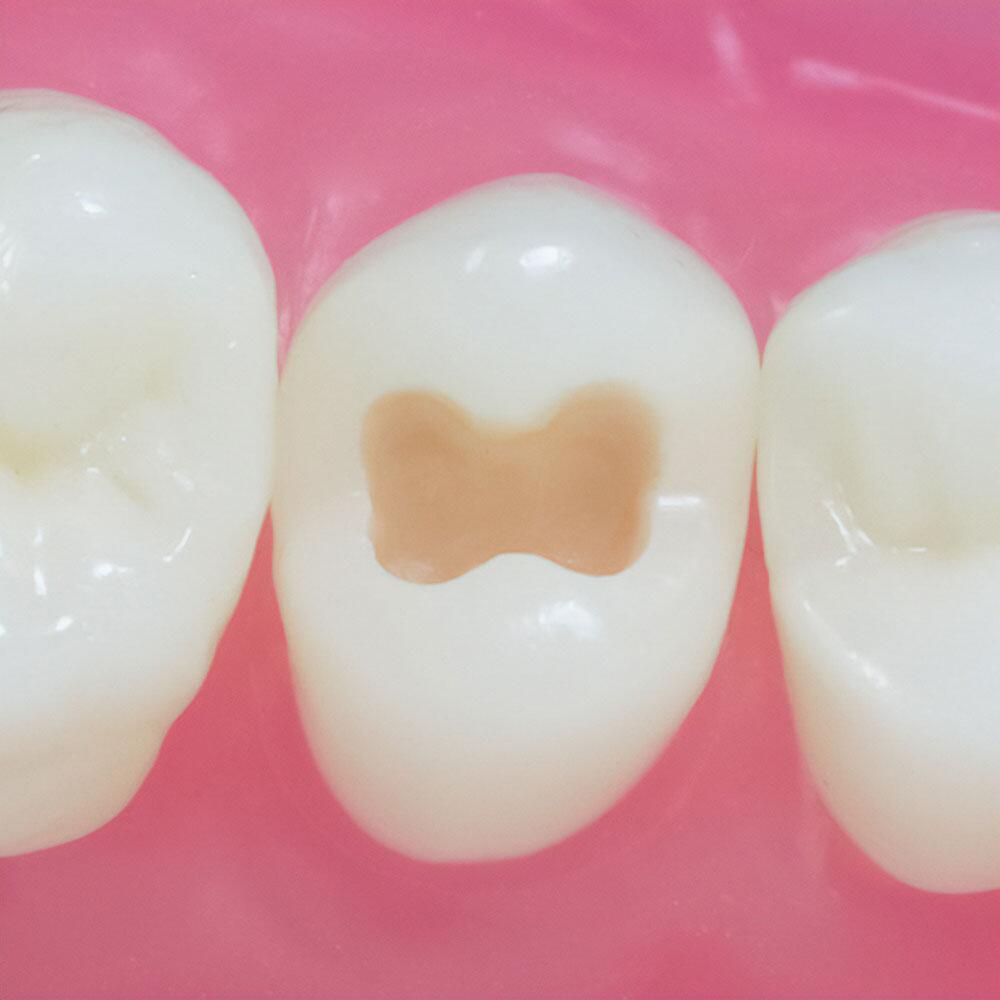Comprar Dente Diferenciado 15 Classe I na Face Oclusal prodens - a ...